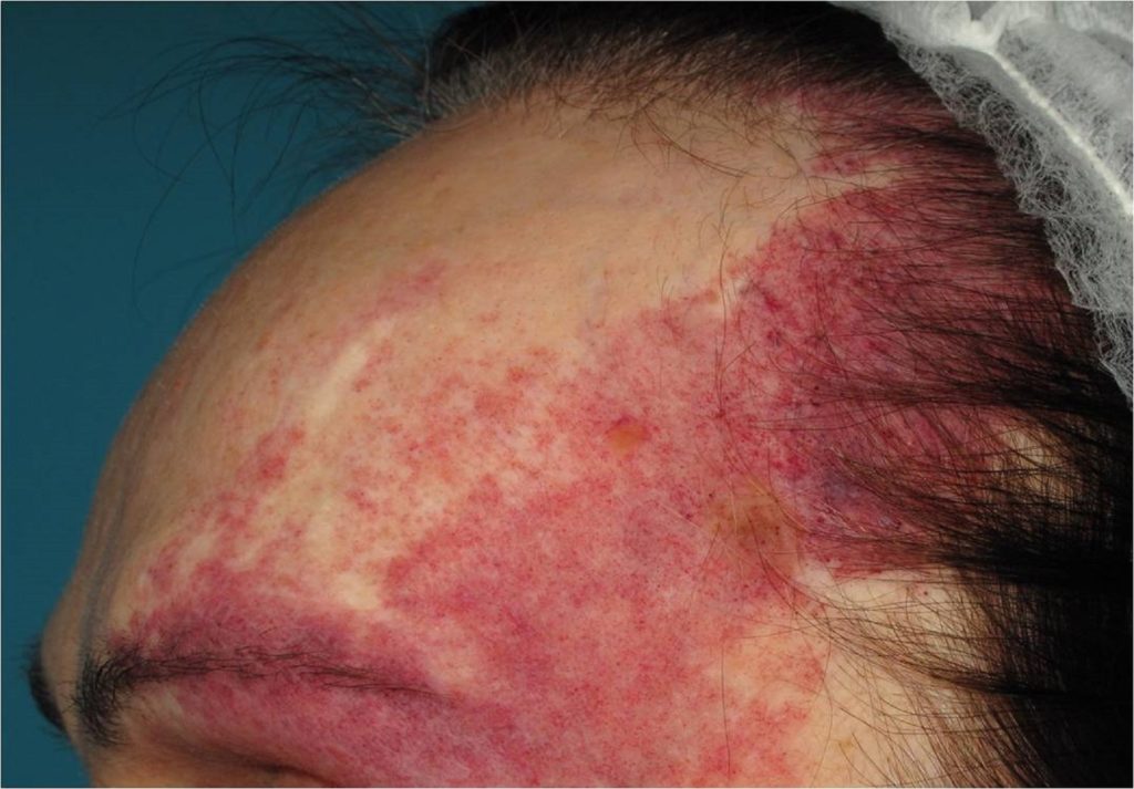 Angiomes ou anomalies vasculaires - Centre épilation laser et ...